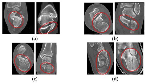 Classification De Sanders Calcaneum At Cynthia Gilliland Blog