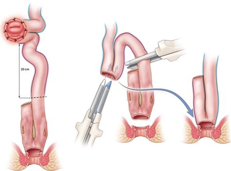 Loop Ileostomy J Pouch