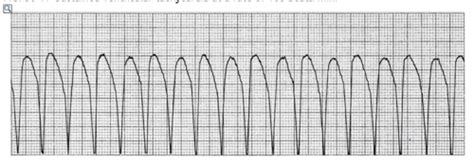 Perfusion Waveforms Ekg Flashcards Quizlet