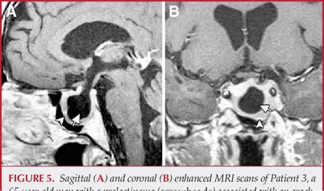 Figure 1 From Arachnoid Diverticula Associated With Anterior Cranial Base Tumors Technical Case