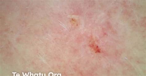 Seborrhoiec Dermatitis Image