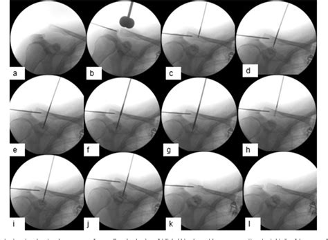Figure 1 From Percutaneous Endobutton Fixation Of Acute Acromioclavicular Joint Injuries And