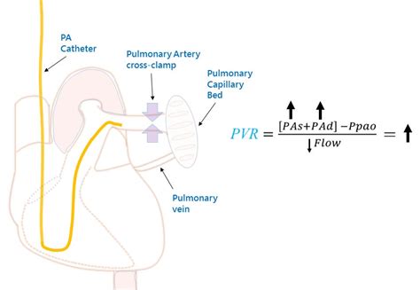 Icu Physiology In 1000 Words The Folly Of Pulmonary Vascular Resistance