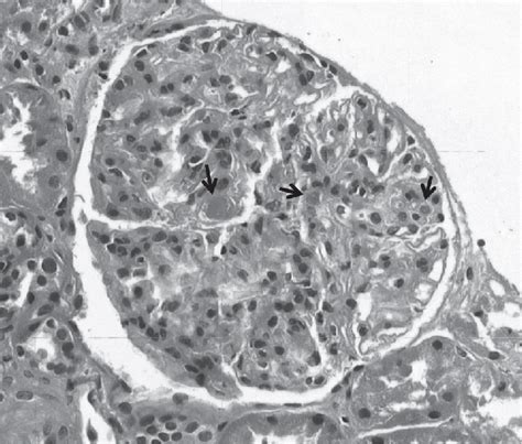 The Glomerulus Displays A Moderate Mesangial Hypercellularity And Download Scientific Diagram