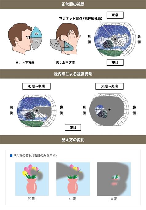 緑内障岐阜県各務原市玉田眼科クリニック