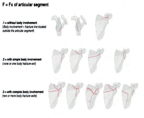 Scapula Fracture Classification Ao At Booker Zuniga Blog