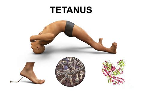 Tetanus Symptoms In Humans