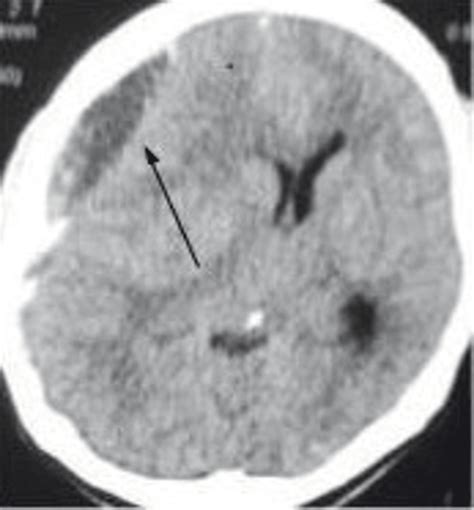 A Ct Scan Of The Brain With Axial View Showing A Mixed Density Picture Download Scientific