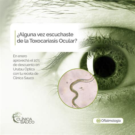 Clínica La Toxocariasis Ocular Es Una Infección Ocular Causada Por