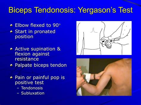 Yergason Test Bicep Tendonitis