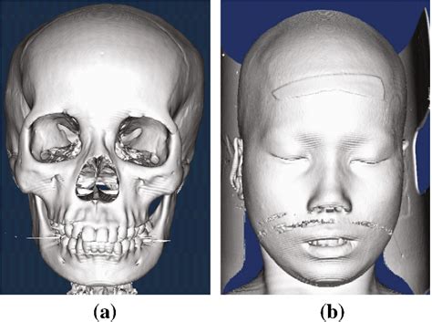 Ct Scan Data To 3d Model At Stephen Jolly Blog