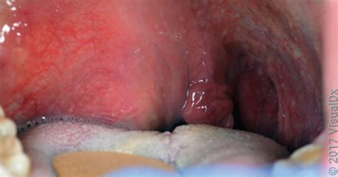 Peritonsillær Abscess