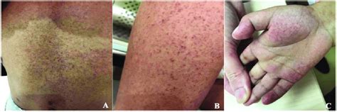 Maculopapular Rash On The Patient A C Punctiform Or Speckled Papules