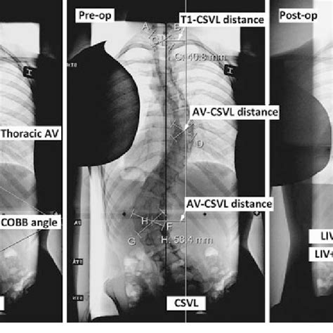 Pdf Lowest Instrumented Vertebra Selection In Lenke 3c And 6c