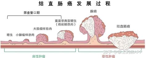 结直肠癌治疗需要做哪些基因检测有哪些靶向药可选可以医保报销吗 知乎