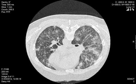 CT Image Showing Alveolar Infiltrates And Reticular Nodular Opacities Download Scientific Diagram
