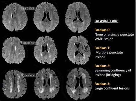 Fazekas Classification Of White Matter Hyperintensities Wmhs