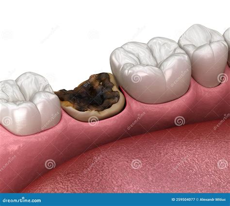 Periodontitis And Gum Inflammation Medically Accurate Dental 3d Illustration Stock Illustration