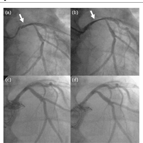 Figure 1 From Left Main Compression By An Aortic Root Abscess Semantic Scholar