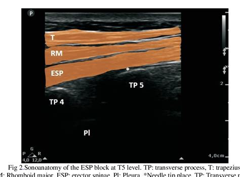 Figure 1 From Ultrasound Guided Erector Spinae Plane Block As Preemptive Analgesia For