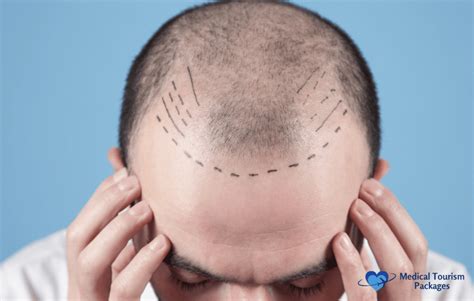 Explore Hair Implants In Colombia Affordable Quality