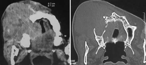 Axial Ct Scan A Soft Tissue Window And B Bone Window Of Case 1