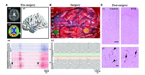 Localization Of The Seizure Onset Zone Soz And Non Seizure Onset Zone