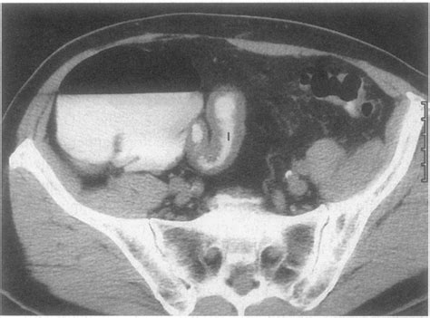 Axial Ct Scan Of An 81 Year Old Man With A Thickened Terminal Ileum