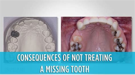 Consequences Of Not Treating A Missing Tooth Missing Teeth Teeth