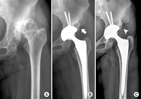 Preoperative Radiograph Showing Crowe Type Iii Developmental Dysplasia
