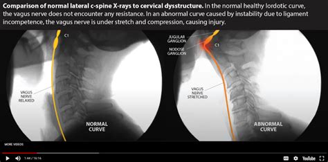 Cervical Spine Nerves Mri