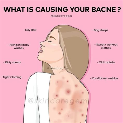 Home Remedies To Get Rid Of Butt Acne And Prevention Tips Artofit