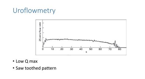 Distal Urethral Stricture Meatal Stenosis Journey Nsfw R Urethralstrictureaid