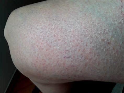 Красные высыпания на ногах Вопрос дерматологу 03 Онлайн