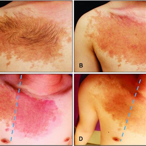 Treatment Response Of The Patient With A Hyperpigmented Patch With