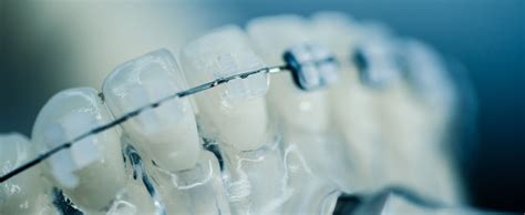 Calgarys Brightest Smiles Lightforce Clear Braces At Marda Loop Braces