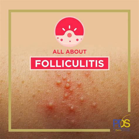 Folliculitis Is An Philippine Dermatological Society