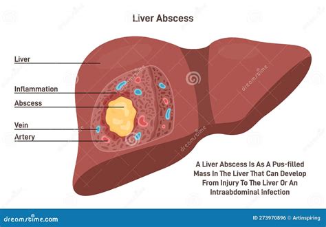 Liver Abscess Human Internal Organ Tissue Inflammation And Pus Formation Vector Illustration