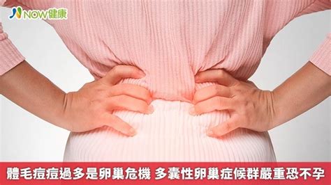 體毛、痘痘過多卵巢陷危機 多囊性卵巢症候群恐釀不孕｜四季線上4gtv
