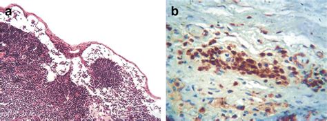 Subcapsular Sinus With Antigenic Stimulation A Extension Of The