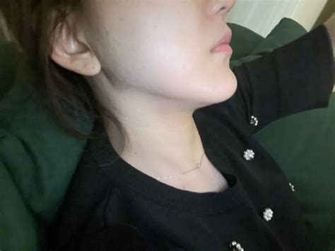 이중턱지방흡입 한달차 얼굴지방흡입 땡기미 및 비용 턱선찾은 후기 네이버 블로그