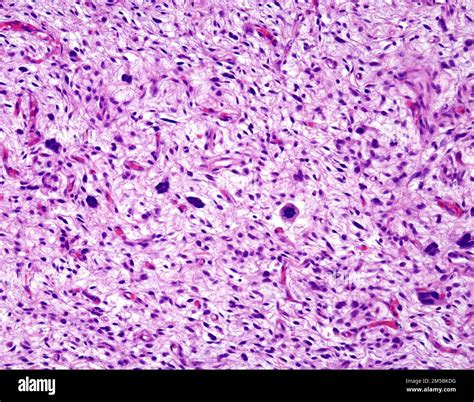 Undifferentiated Pleomorphic Sarcoma Light Micrograph Undifferentiated Pleomorphic Sarcoma