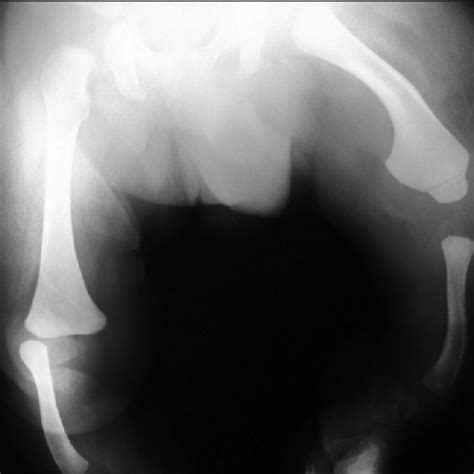 X Ray Showing Bilateral Absence Of The Tibia With Intact Fibulae And Download Scientific