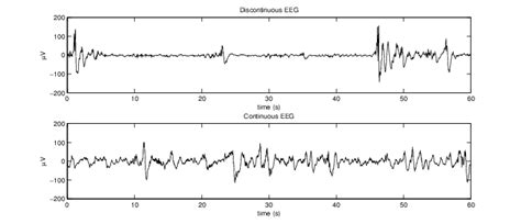 Examples Of 60 Seconds Of Eeg That Are Classified As Discontinuous Top