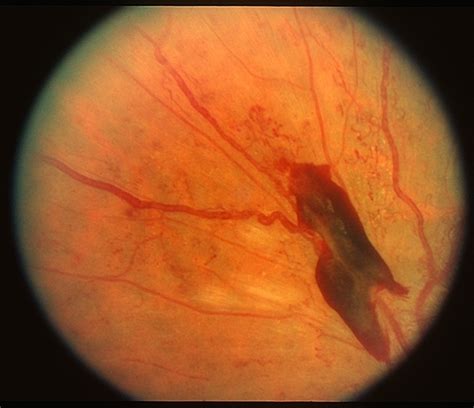 Retinal Neovascularization Retina Image Bank