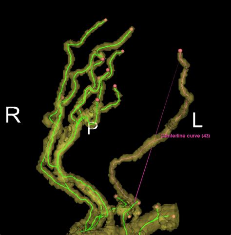 Vmtk Extract Centerline Extracts Centerline Curves With Both A Curve And A Straight Line