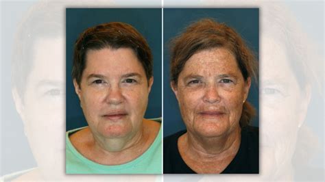 Photos Showing Effects Of Sun Exposure And Smoking On Identical Twins