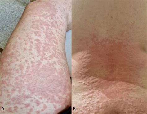 Systemic Allergic Dermatitis To Cyanoacrylate Used For Embolisation