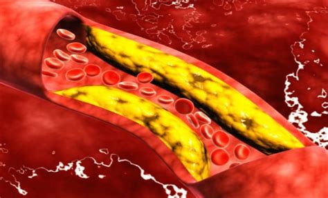 4 კოვზი ეს მიქსტურა და სამუდამოდ დაემშვიდოებთ წნევას ქოლესტერინს და არტერიების შევიწროვებას