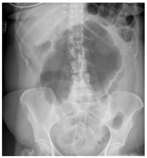Cecal Volvulus Vs Sigmoid Volvulus